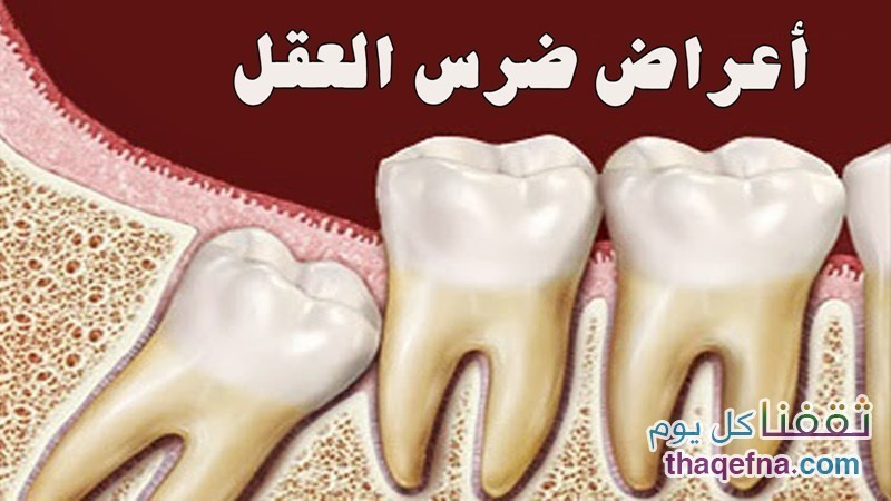 ضرس العقل لماذا سميّ بهذا الإسم؟ وما علاقته بالعقل؟ وكم عددهم